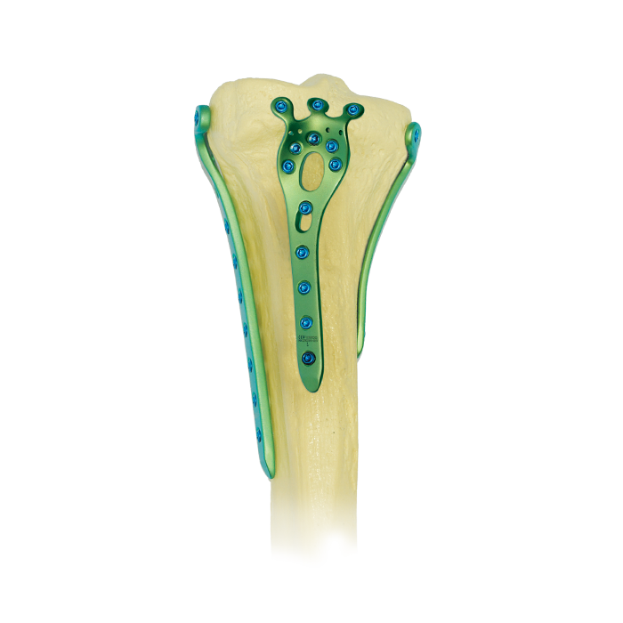 Three-column Fixation System Of Proximal Tibial Plateau,Medical Device ...