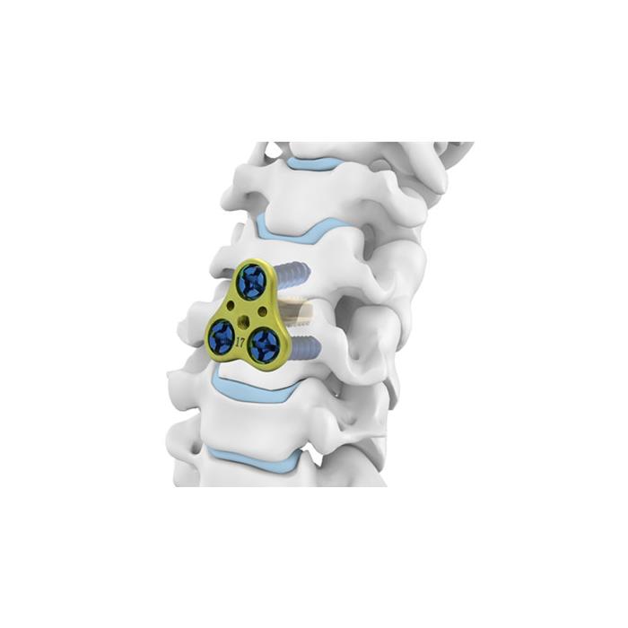Titanium Mesh Cages (TMC) in Spine Surgery | Spine Implants ...