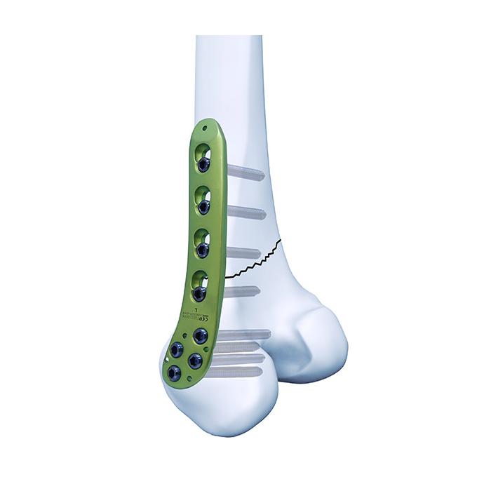 Distal Medial Femoral Sub-condylar Locking Plate,Medical Device ...