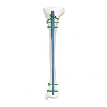 UTN Universal Tibial Nail,Medical Device Manufacturers -Double Medical