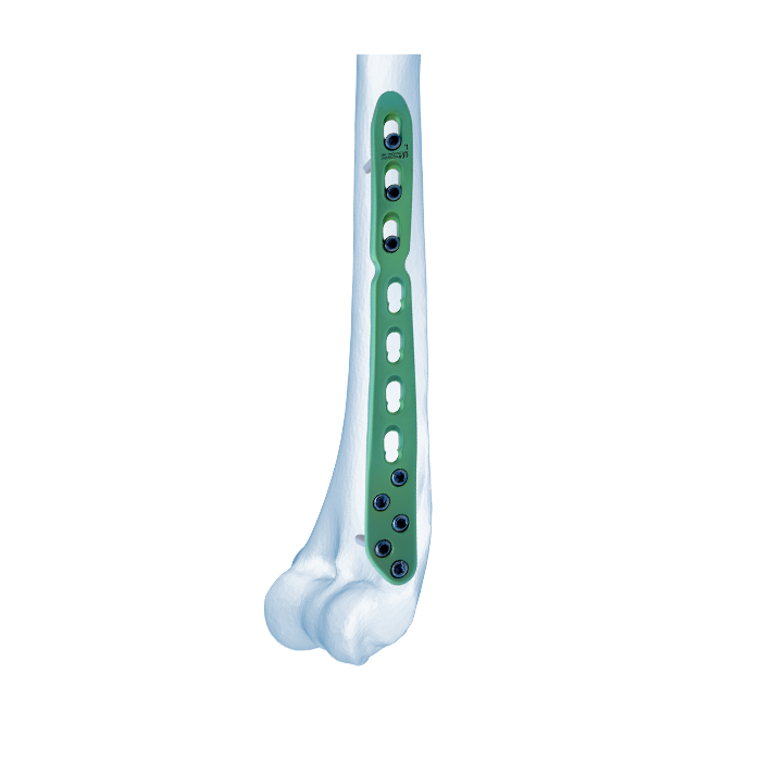 Distal Humeral Sub-condylar Locking Plate,Medical Device Manufacturers ...