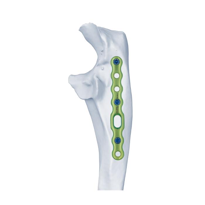 Olecranon Fixation System,Medical Device Manufacturers -Double Medical
