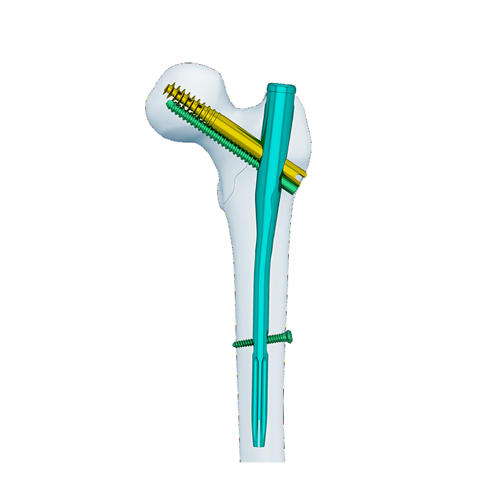 PFCN Proximal Femoral Compression Nail,Medical Device Manufacturers ...